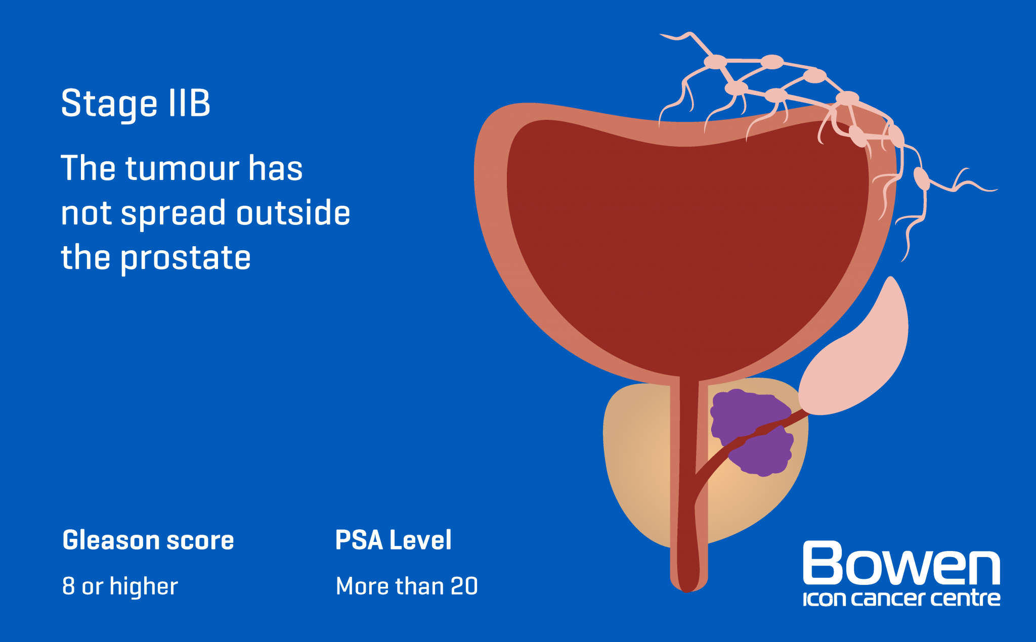 What Is Prostate Cancer Prostate Cancer Explained — Bowen Icon Cancer