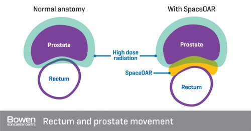 SpaceOAR - Prostate Hydrogel Spacer — Bowen Icon Cancer Centre